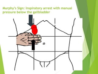 Gall stones disease | PPT