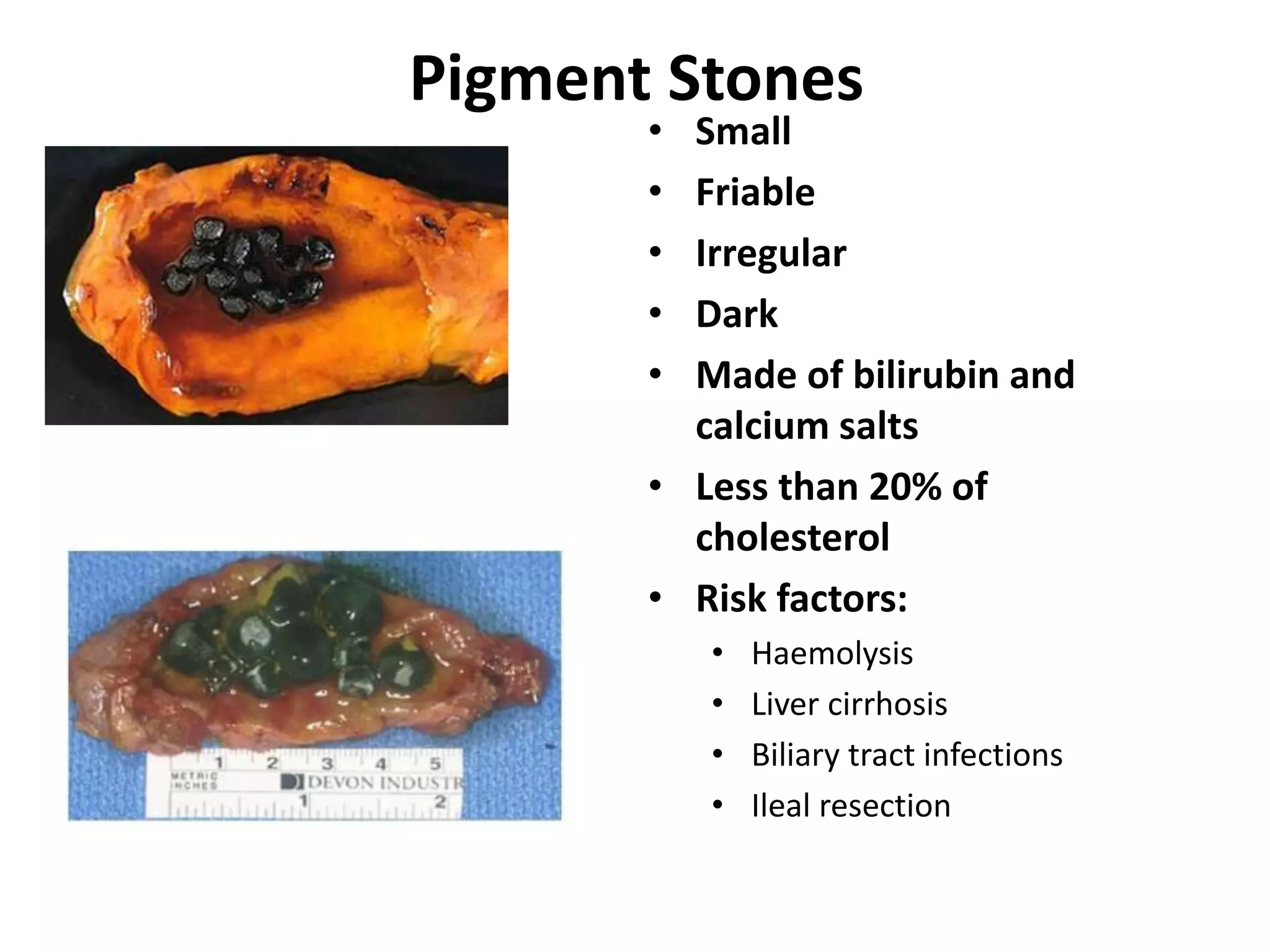 gall_stones.ppt