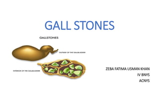 gall stones.pptx