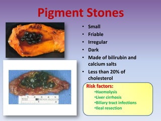gall_stones.pptx
