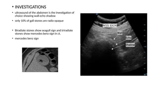 Gallstones medicine seminar model notes.pptx