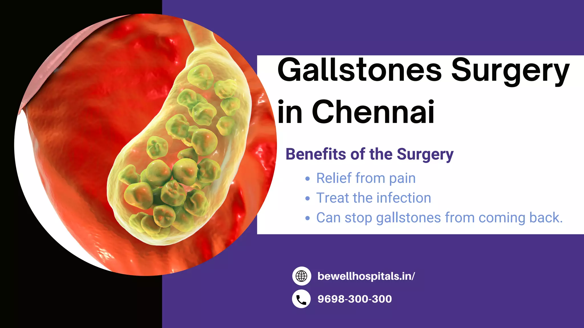 Gallstones Surgery in Chennai.pdf