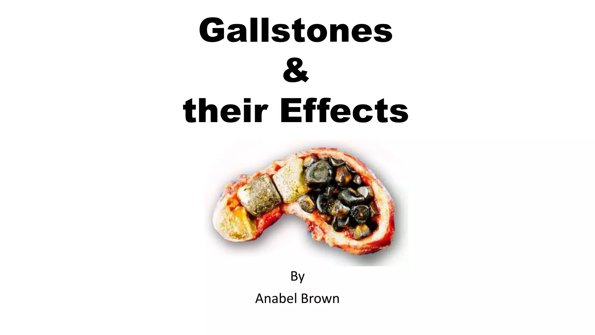 Gallstones & their Effects.pptx | Digestive Disorders | Diseases and ...