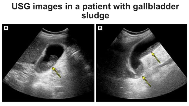 Gallstones & their Effects.pptx | Digestive Disorders | Diseases and ...