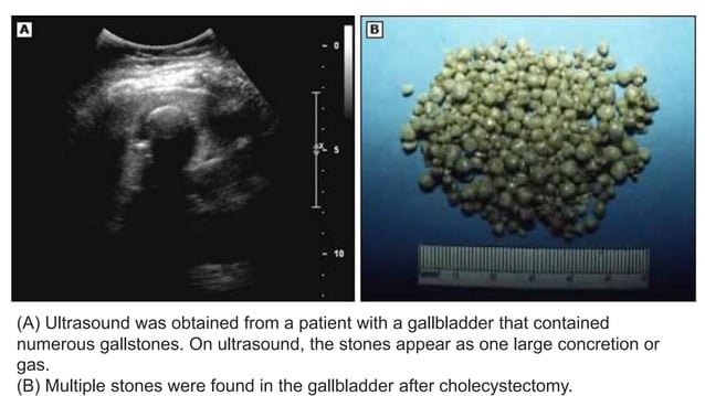 Gallstones & their Effects.pptx | Digestive Disorders | Diseases and ...