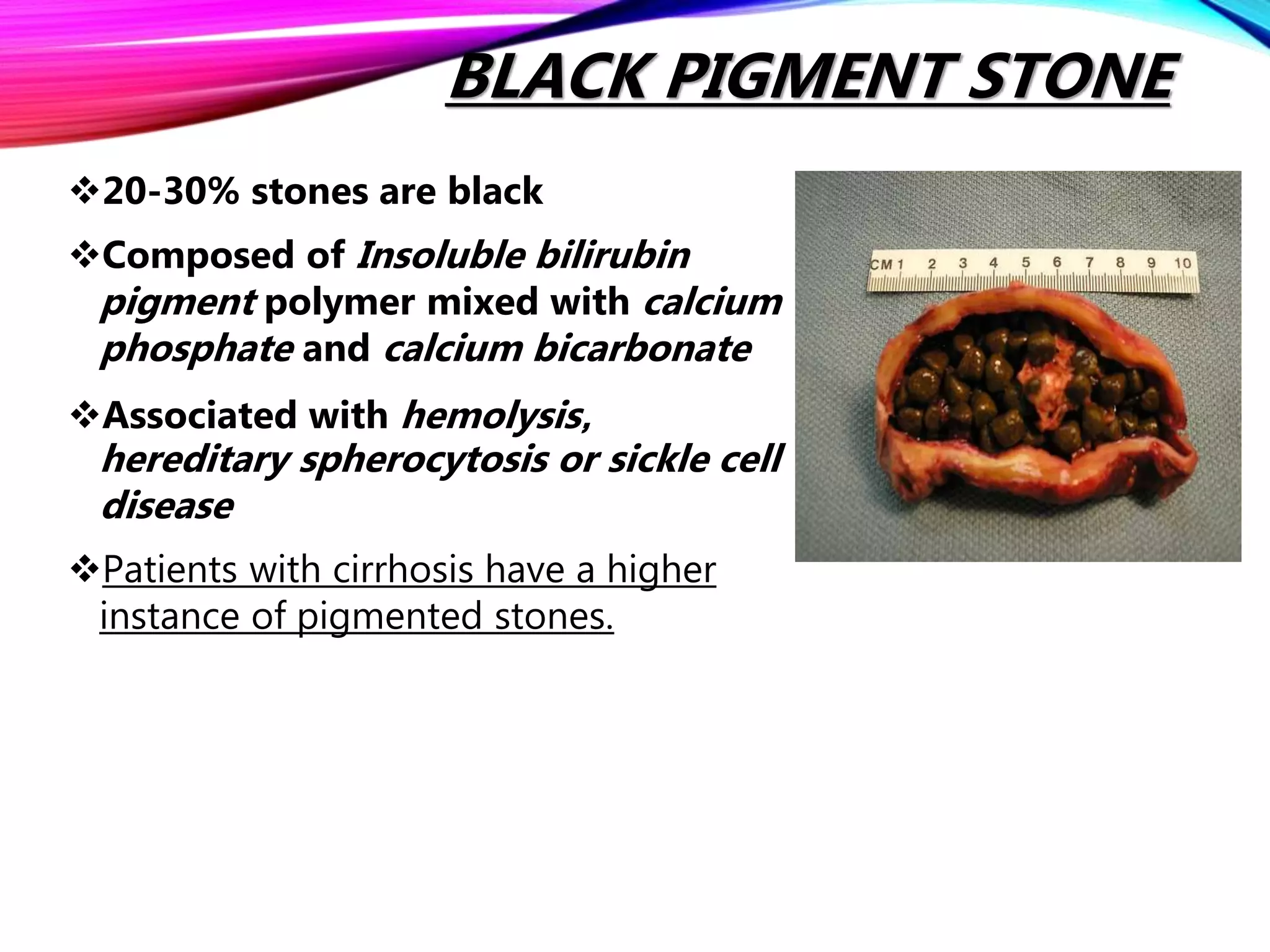 Gallstones and it's Complications | PPTX