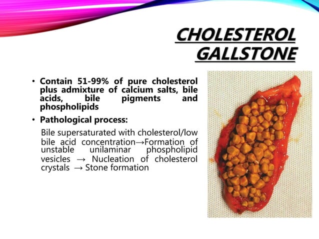 Gallstones and it's Complications | PPTX | Digestive Disorders ...