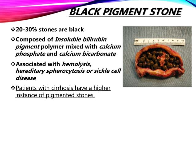 Gallstones and it's Complications | PPTX | Digestive Disorders ...