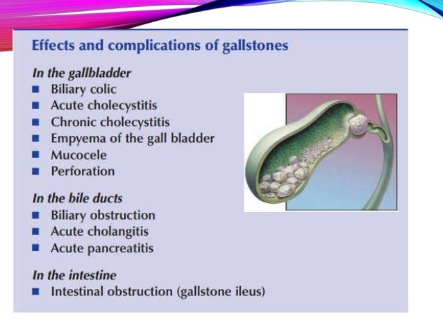 Gallstones and it's Complications