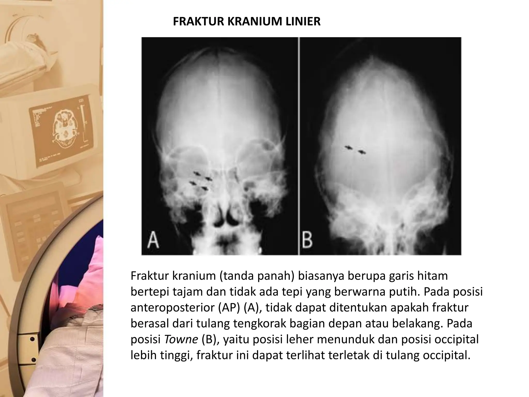 Gambaran CT Scan Radiologi CT Scan Radio | PPTX
