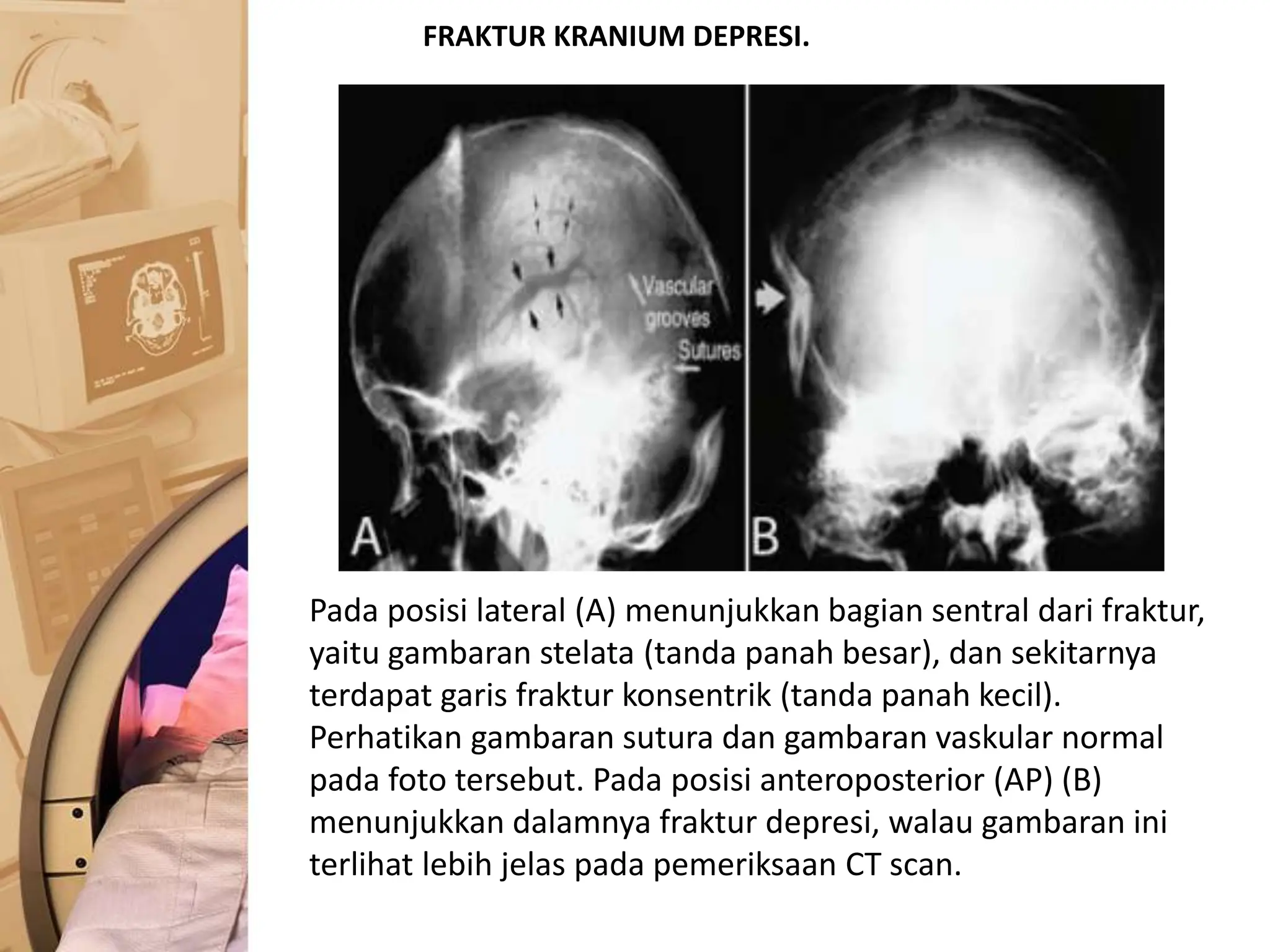 Gambaran CT Scan Radiologi CT Scan Radio | PPTX