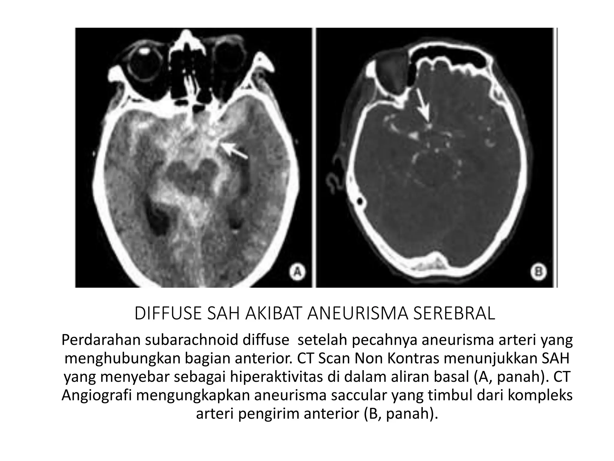Gambaran CT Scan Radiologi CT Scan Radio | PPTX