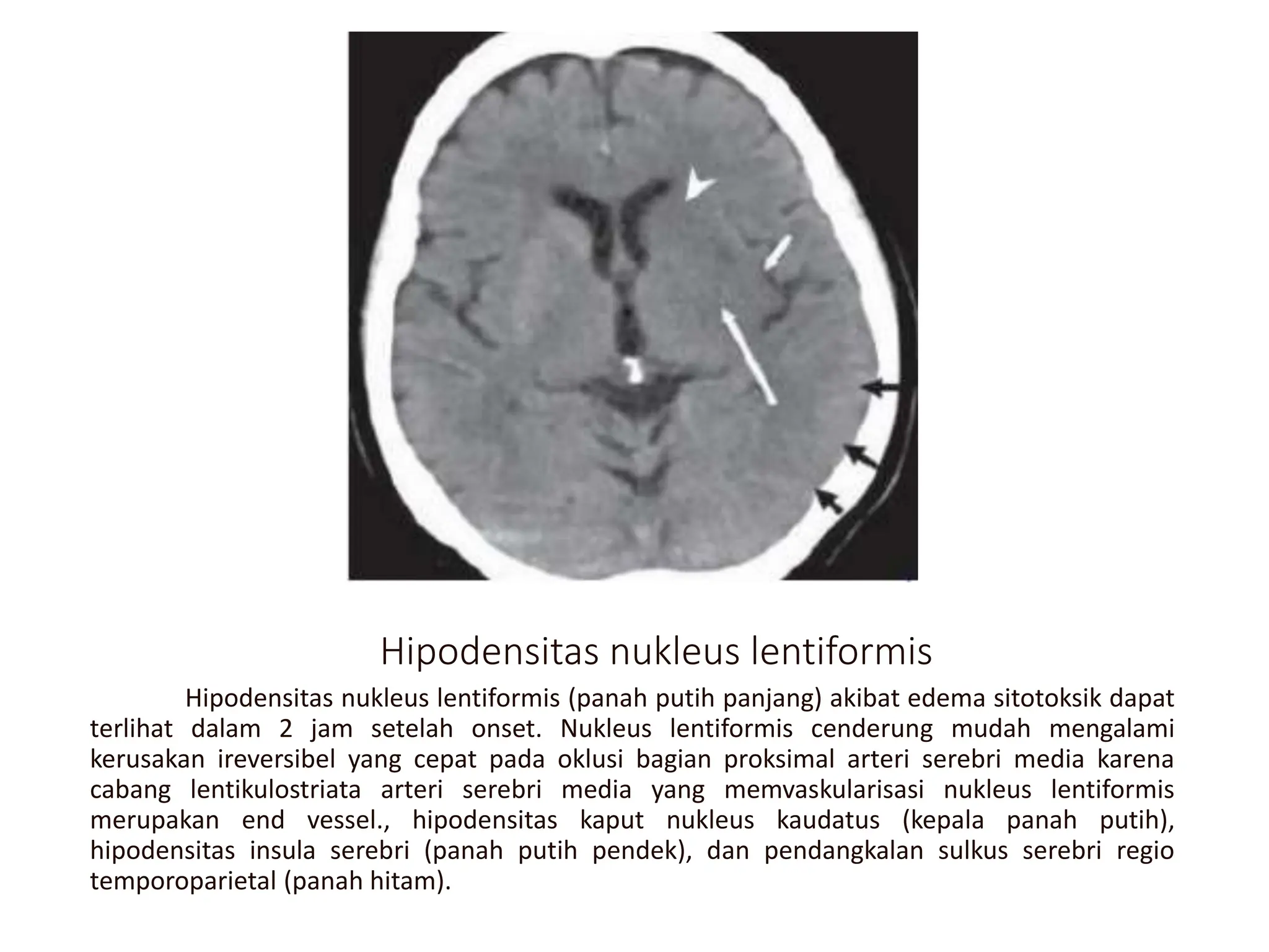 Gambaran CT Scan Radiologi CT Scan Radio | PPTX
