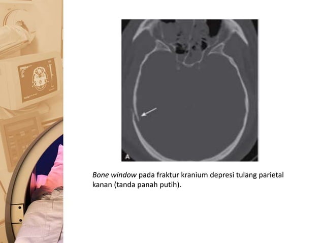 Gambaran CT Scan Radiologi CT Scan Radio | PPTX