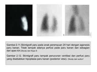 referat Gambaran radiologi agenesis paru | PPTX
