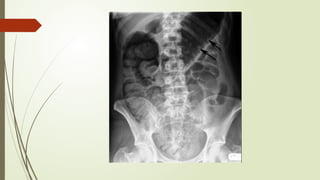 Gambaran Radiologi Megakolon Toksik.pptx