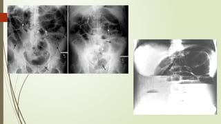 Gambaran Radiologi Megakolon Toksik.pptx