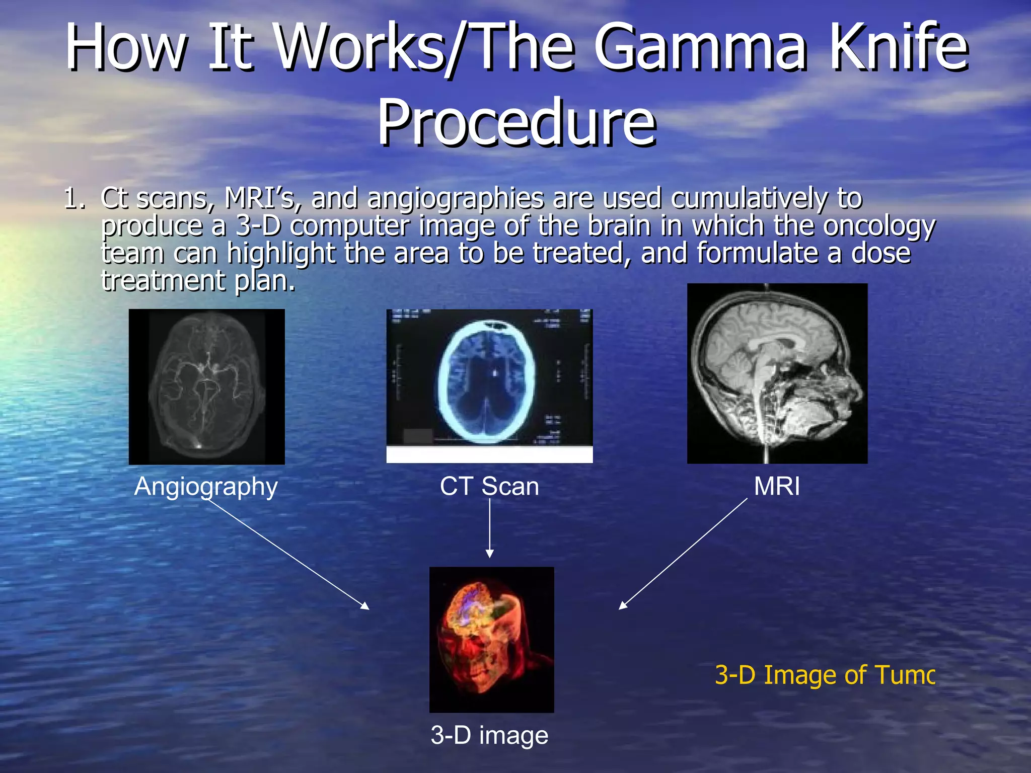 Gamma Knife | PPT