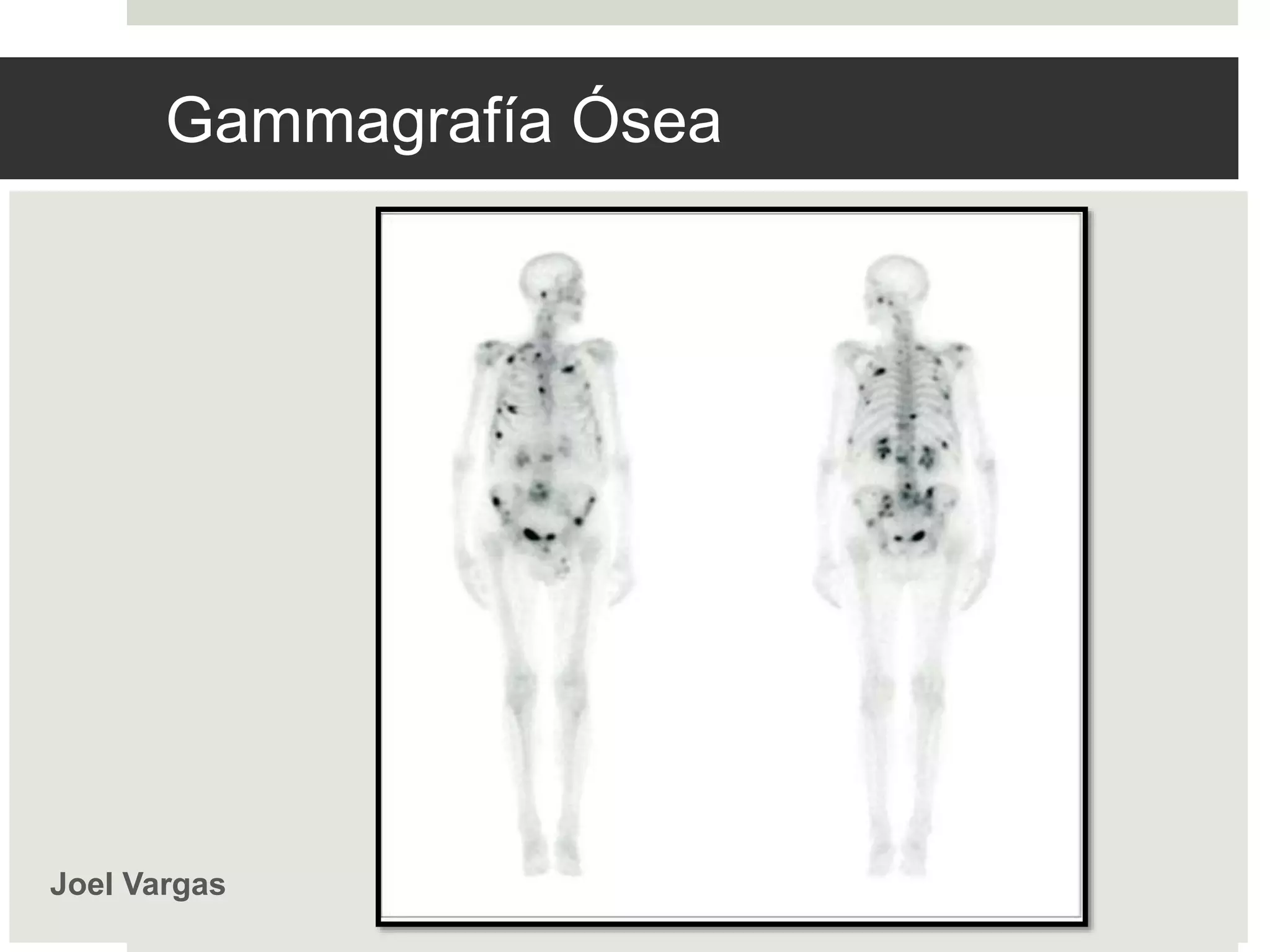 Gammagrafia osea | PPTX