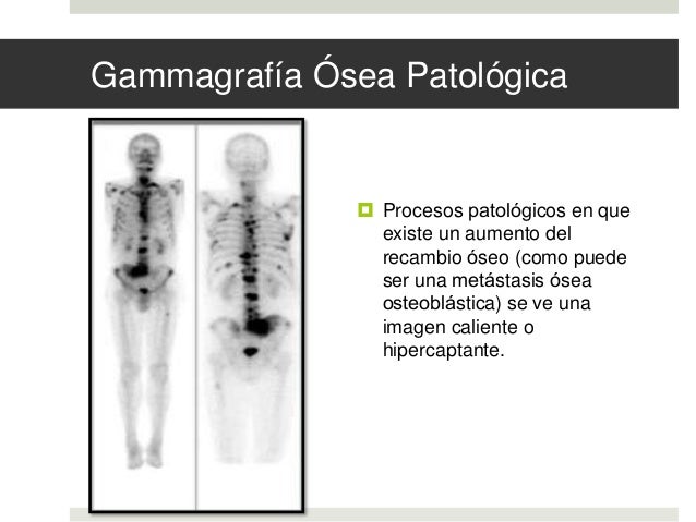 Gammagrafia osea