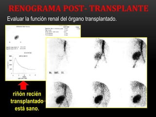 ESTUDIOS COMPLEMENTARIOS: Gammagrafia Renal | PPTX