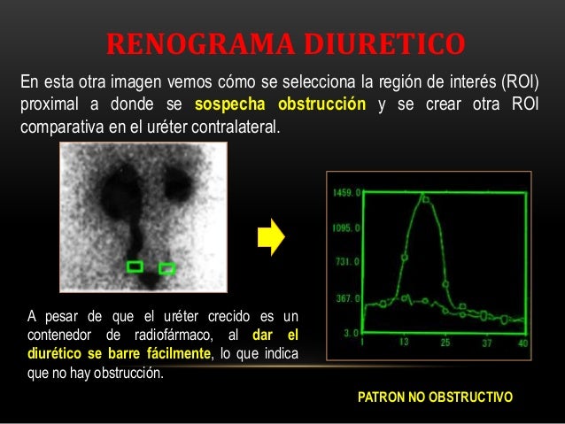 ESTUDIOS COMPLEMENTARIOS: Gammagrafia Renal