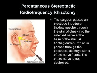 Trigeminal nerve and Gamma knife treatment | PPT