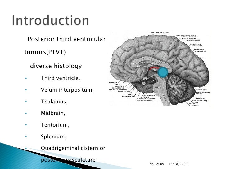 Gamma knife in posterior third ventricular tumors