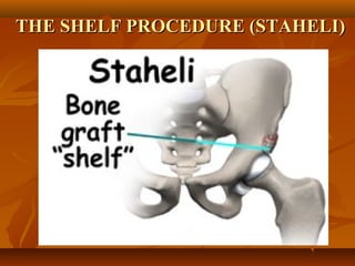 osteotomies around hip by dr gandhi | PPT
