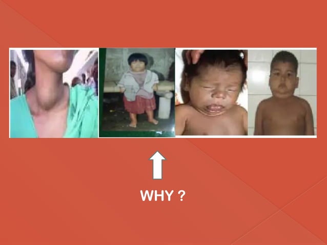 GANGGUAN AKIBAT KEKURANGAN YODIUM (GAKY) PPT.pptx