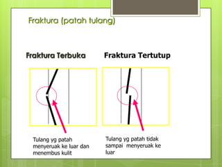 Gangguan dan kelainan pada tulang | PPTX