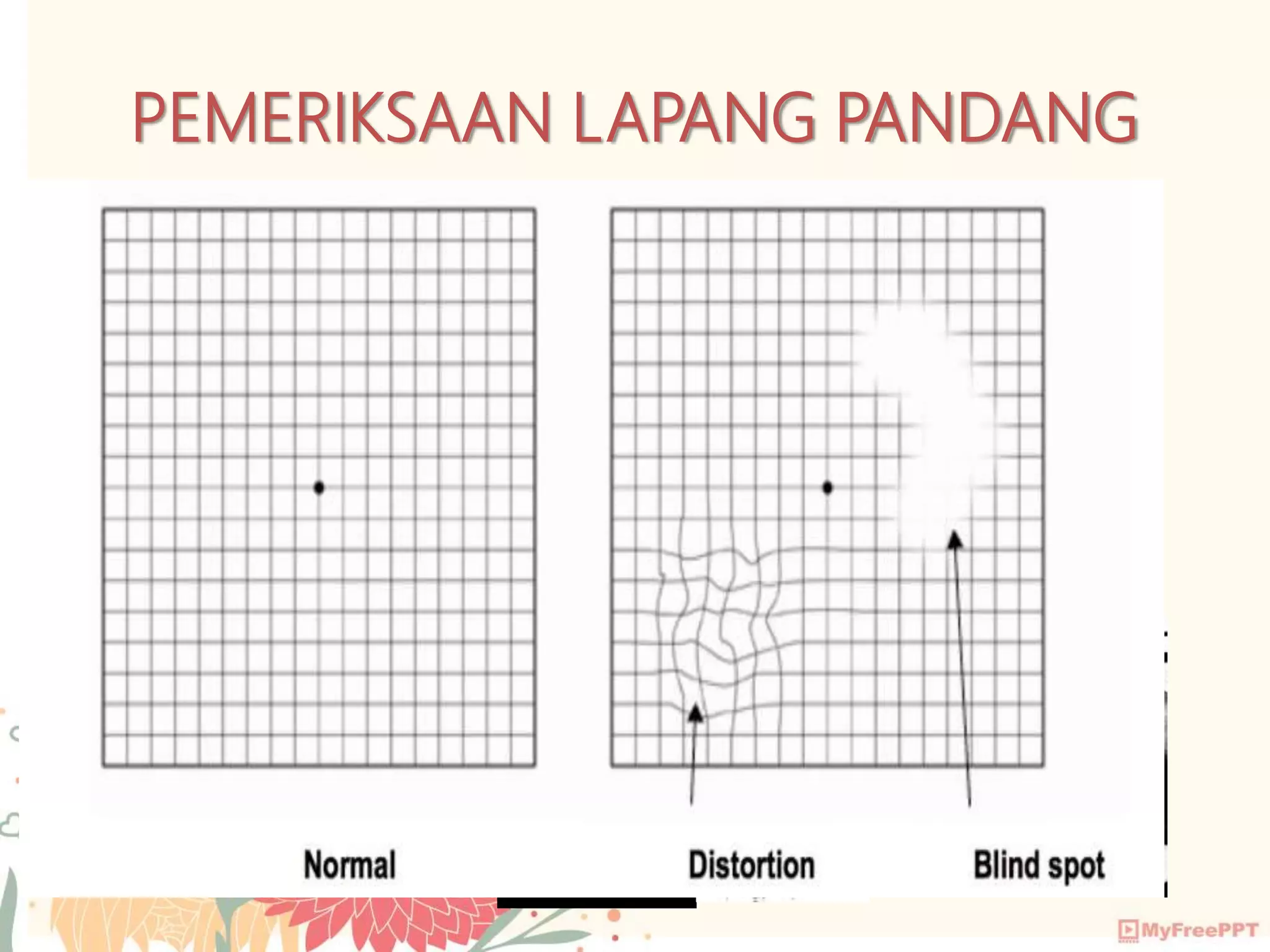 Gangguan lapang pandang by Gabriella | PPTX