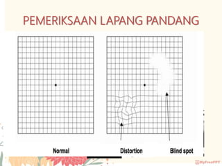 Gangguan lapang pandang by Gabriella | PPTX