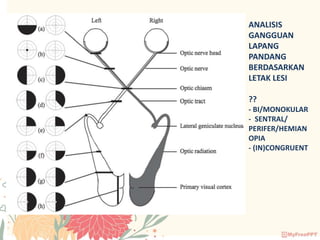 Gangguan lapang pandang by Gabriella | PPT