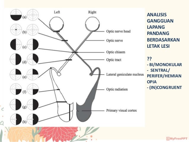 Gangguan lapang pandang by Gabriella