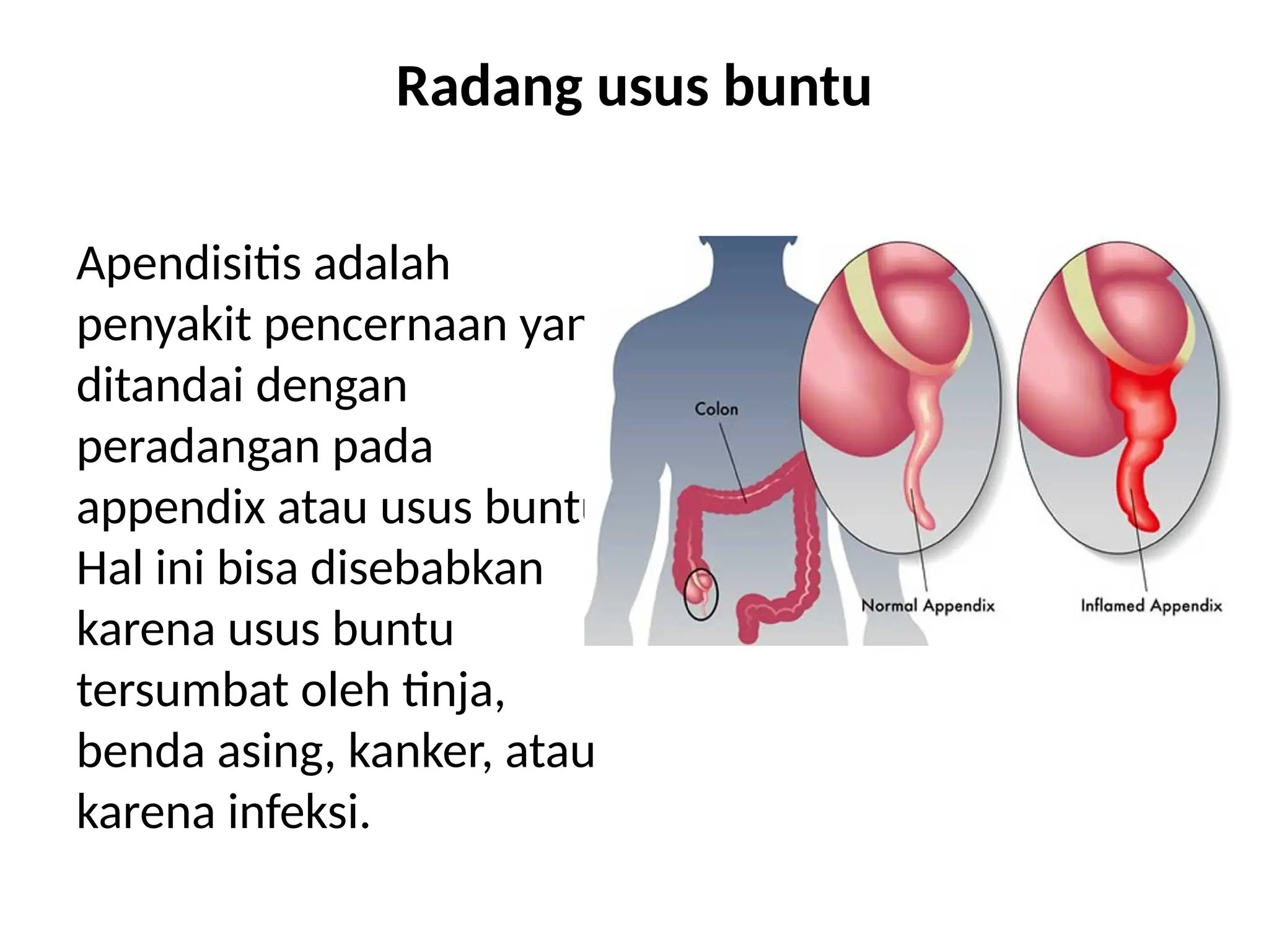 Gangguan pada sistem pencernaan pada manusia.pptx