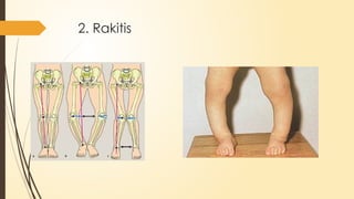 GANGGUAN SISTEM GERAK pada manusia kelas xi.pptx