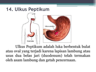Gangguan pada sistem pencernaan biologi | PPTX