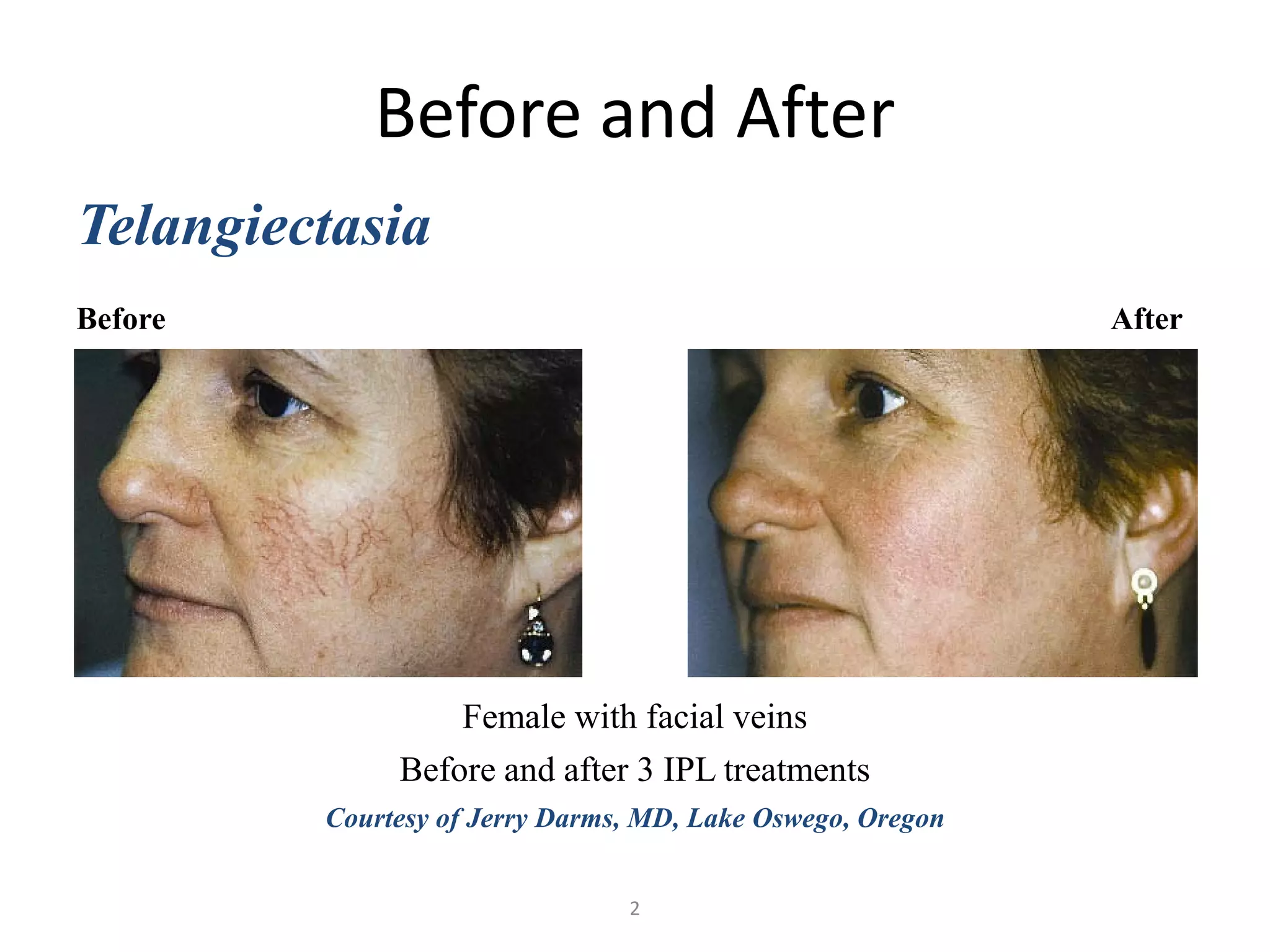 IPL Before and After | PDF | Skin and Dermatology | Diseases and Conditions