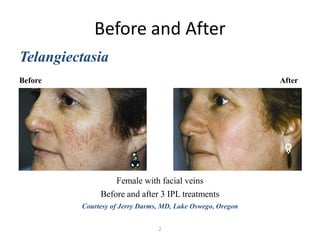 IPL Before and After | PDF