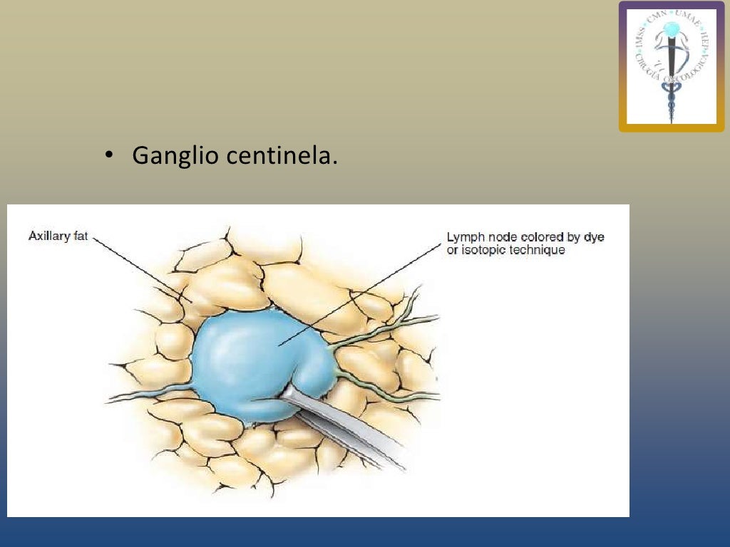 Ganglio centinela