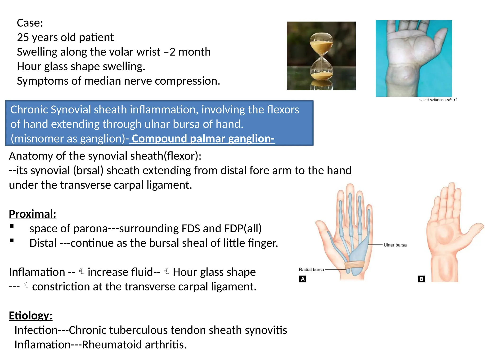 ganglion and compound palmar ganglion..pptx