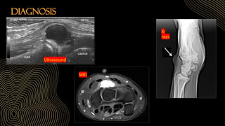 Ganglion cyst -The Silent Swell : Unveiling the Mystery of the Ganglion ...