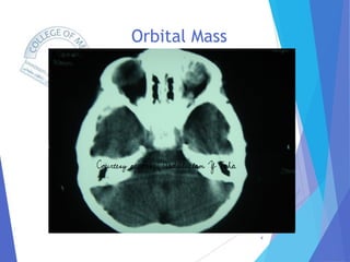 Ganglioneuroblastoma of the Posterior Mediastinum in a Child.pdf