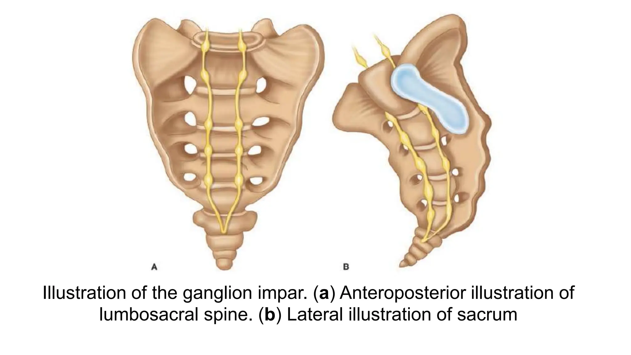 Ganglion Impar Block- Dr Minhaj Akhter ppt.pdf