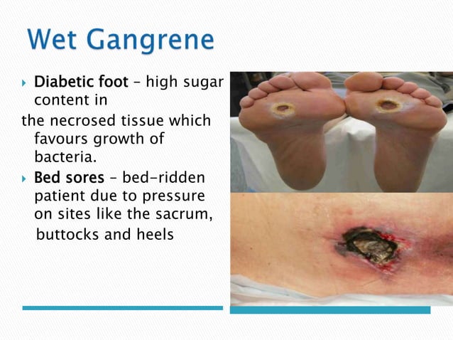 Gangrene | PPTX | Blood Disorders | Diseases and Conditions