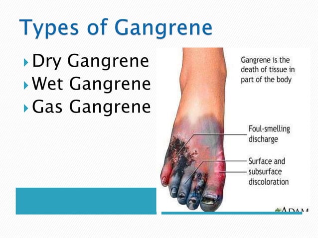 Gangrene | PPTX | Blood Disorders | Diseases and Conditions