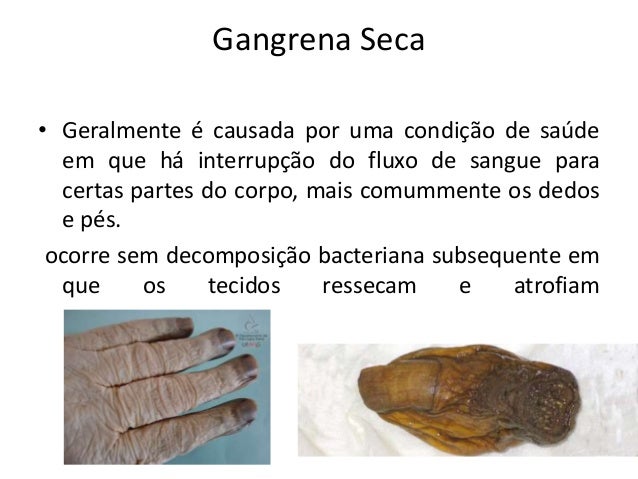 Gangrena