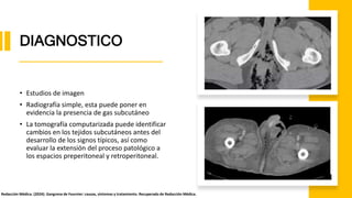 Gangrena de Fournier signos y sintomas, bacterias relacionadas | PPT
