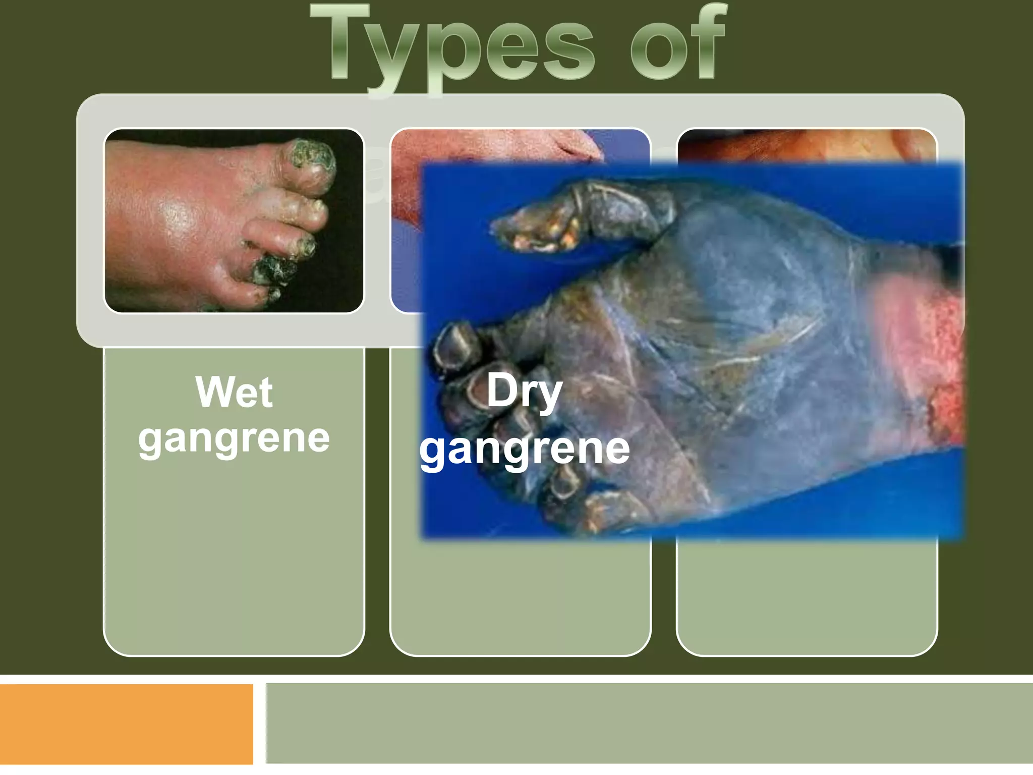 Gangrena de fournier | PPTX